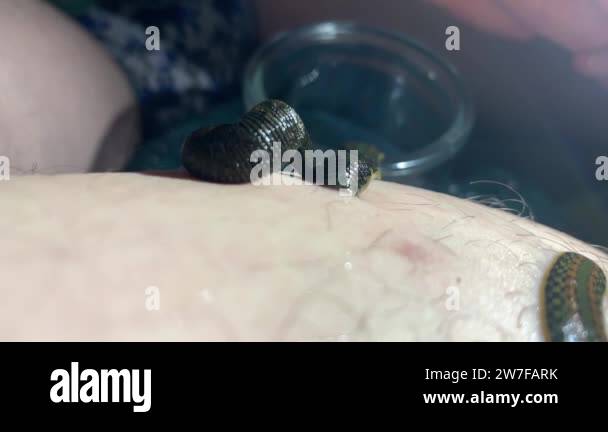 Parasitic worm leg Stock Videos & Footage - HD and 4K Video Clips - Alamy
