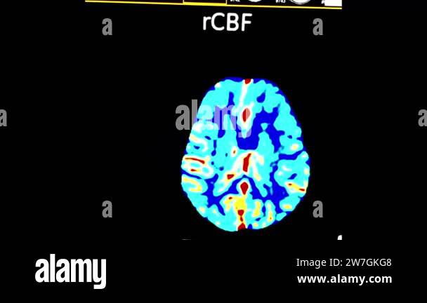 Brain Perfusion Imaging - Cerebral Angiography in Color Stock Video ...