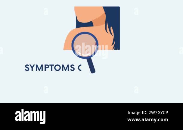 Melanoma ABCDEs symptoms animation like big diameter, asymmetry, uneven ... Melanoma ABCDEs symptoms animation like big diameter, asymmetry, uneven ...