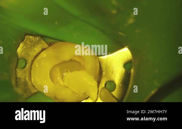 Hollow tooth Stock Videos & Footage - HD and 4K Video Clips - Alamy