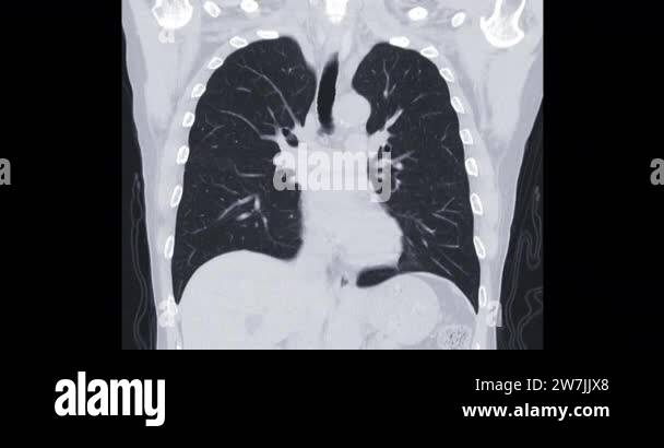 CT Chest or CT Scan of Lung Coronal MIP View for diagnosis TB ...