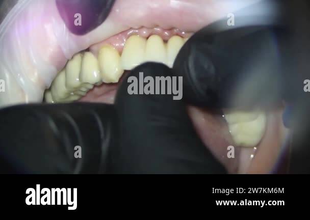 dentistry. shooting with a microscope. Installation of metal-plastic ...