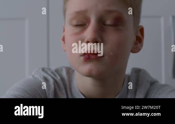 Concept of adolescent violence. Upset battered teenage boy with wounds ...