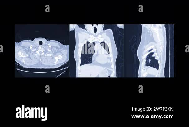 Compare of CT Chest or CT Scan of Lung Axial ,Coronal and sagittal MIP View for diagnosis TB ...