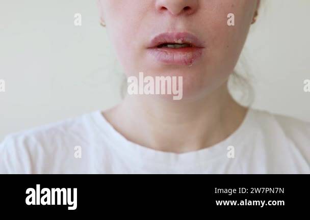Close up of girl lips affected by herpes. Treatment of herpes infection ...