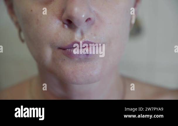 Dermatological disease, herpes, on the lips of a woman. Viral infection ...
