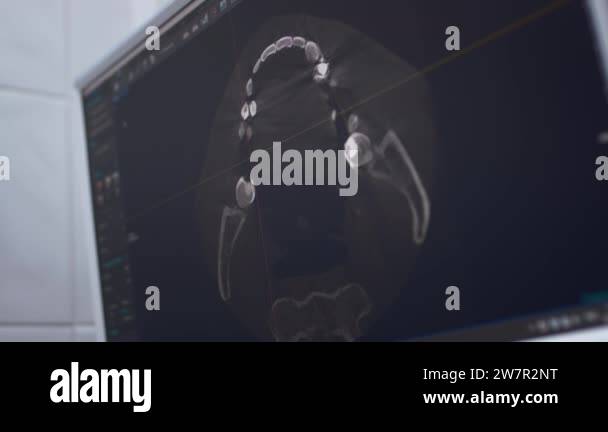 Dentist doctor examines a panoramic x-ray of the jaw on a computer ...