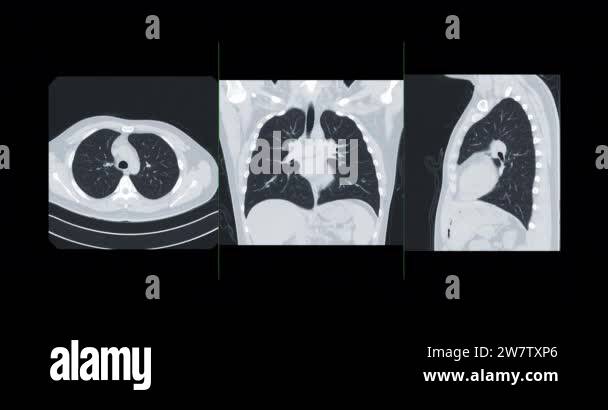 CT Chest or CT Lung axial view soft tissue and lung window for ...
