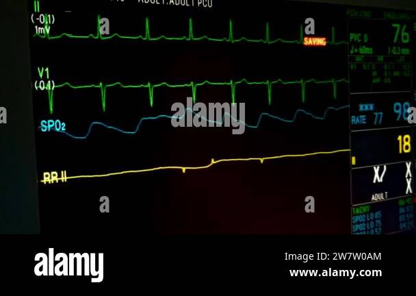 EKG, Pulse, Oxygen and Respiration ICU Monitor Screen Stock Video ...