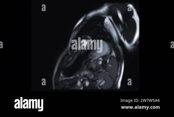 MRI heart or Cardiac MRI ( magnetic resonance imaging of heart ...