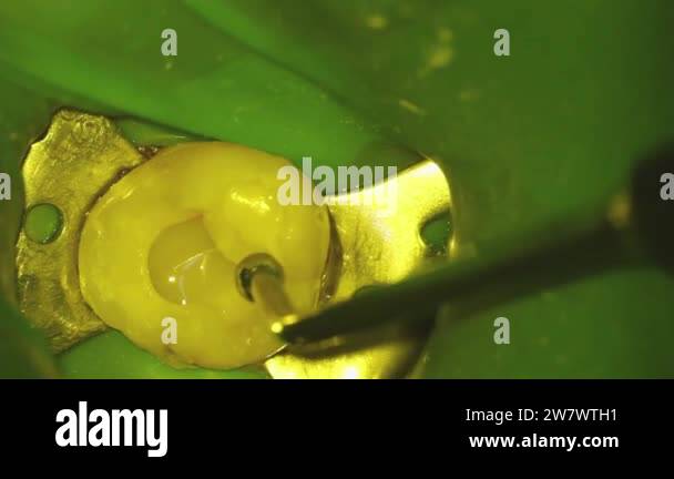 dentistry. shooting with a microscope. dental treatment. alignment with ...