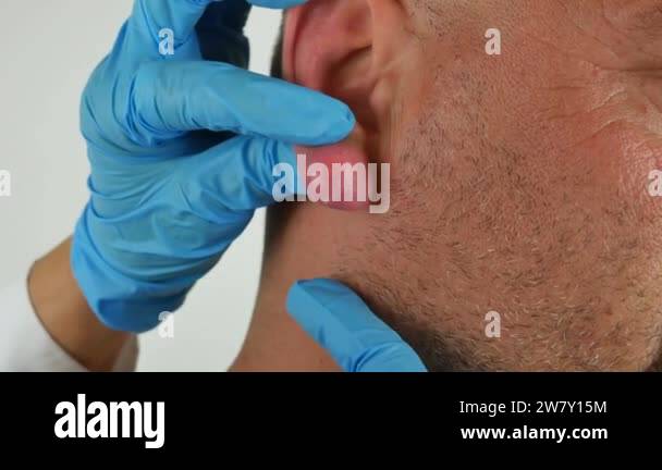 Swollen abscess Stock Videos & Footage - HD and 4K Video Clips - Alamy