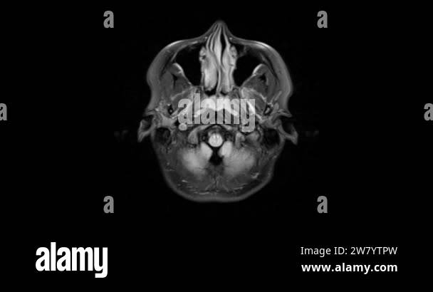MRI of the brain. Human skull vertical projection. Medical footage ...