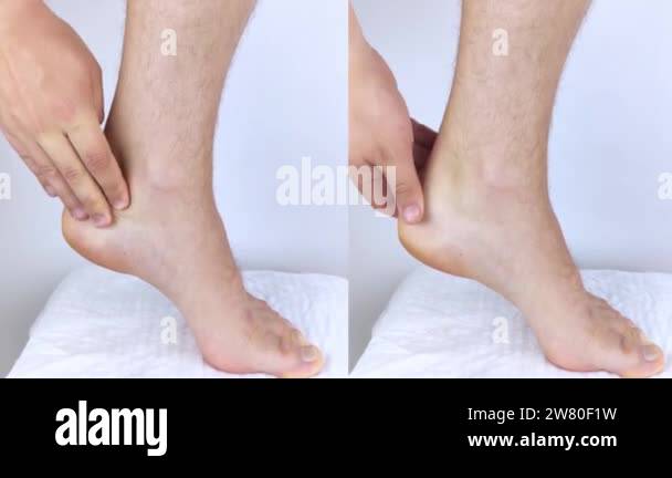 Before and after. On the left, a man holds on to a sore heel that hurts ...