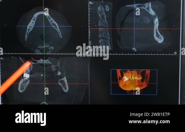 Dentist pointing at teeth scanning on X-ray picture and explaining ...