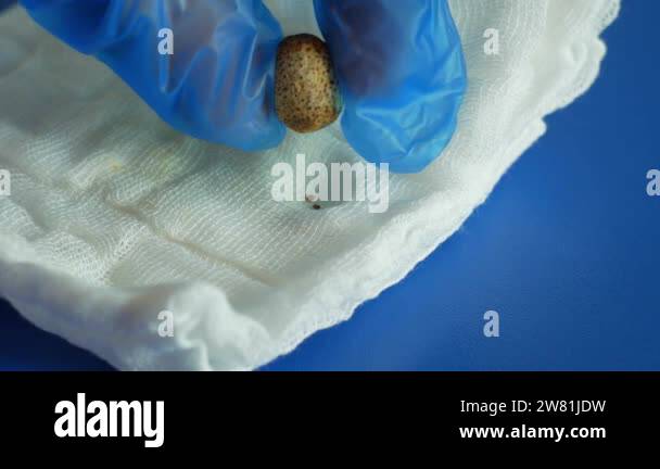 Removed gallstones on compress after gallbladder laparoscopic surgery ...