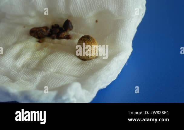 Removed gallstones on compress after gallbladder laparoscopic surgery ...