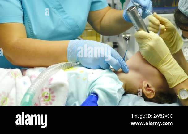 Patient endotracheal tube in Stock Videos & Footage - HD and 4K Video ...