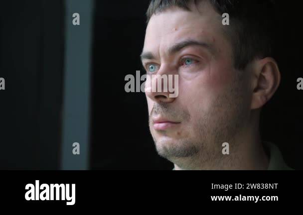 Sick Man with One Annoyed Red Blood Eye with Symptom of Conjunctivitis ...