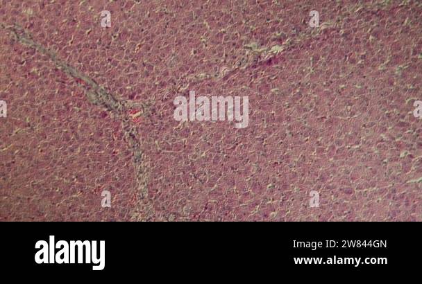 Liver disease tissue under the microscope 100x Stock Videos & Footage ...