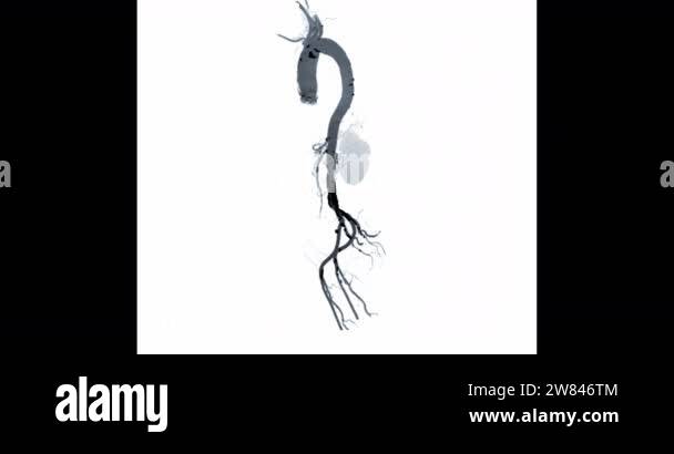 CTA whole aorta around on the screen for diagnosis aortic aneurysm ...