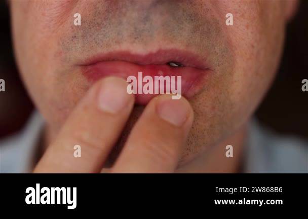 recurrent aphthous ulcers or canker sores, sore lip. Aphthous ...