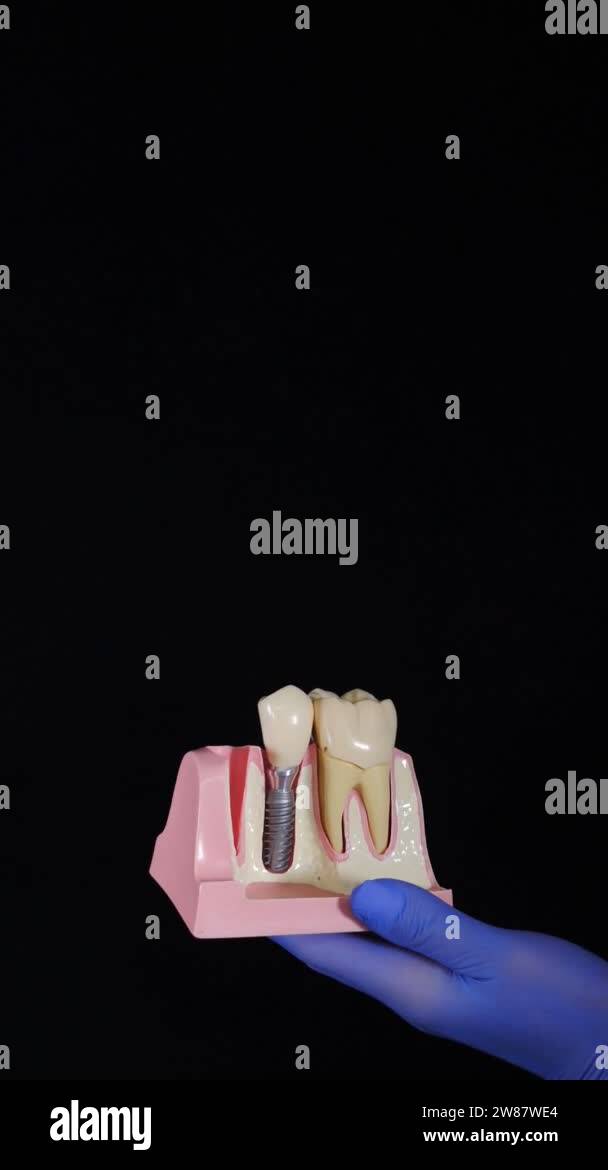 Tooth extraction concept. Dentistry and teeth care concept. Dental ...