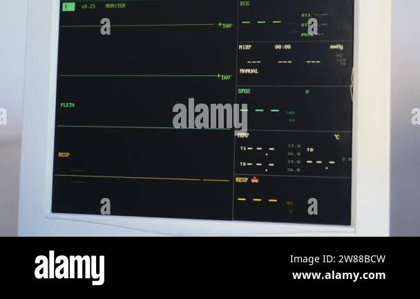 No heart rate on ECG monitor during surgery operation reanimation death ...