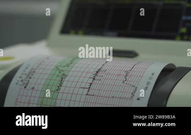 Electronic Cardiotocography Machine Monitoring Fetal Heart Contractions ...
