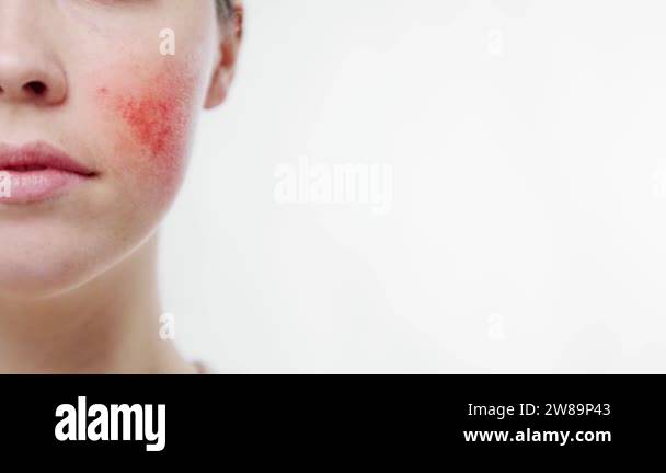 A woman's face with a red inflamed cheek close-up. A females hand ...
