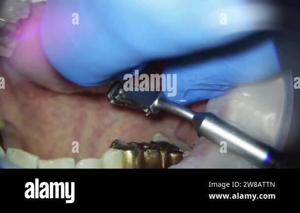 dentistry. video filming under a microscope. removal of a gold crown on ...