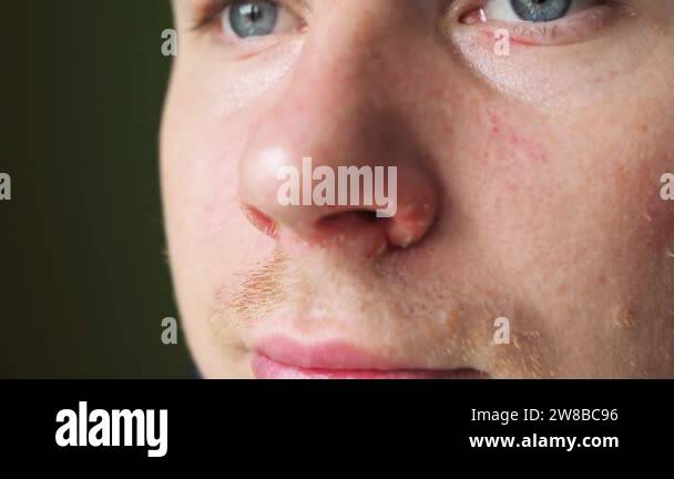 a sore nose after a runny nose close-up. cracked skin on the nose. sore ...