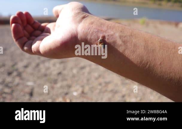 treatment by honey bee sting. closeup honey bee stinging a hand. close ...