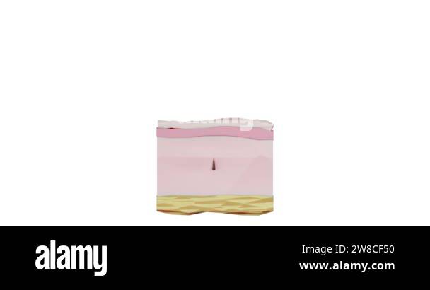 3d render animation macro-level skin structure of the stages of the ...