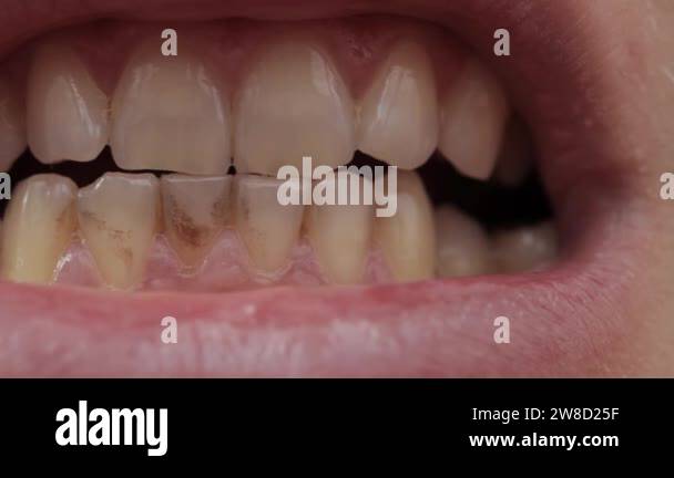 Rotten human teeth, close-up. Dental calculus in dentistry, black tooth ...
