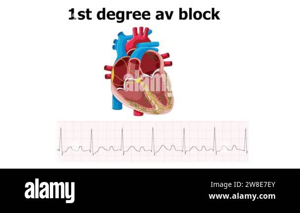 ecg shows first degree av block with heart animation Stock Video ...