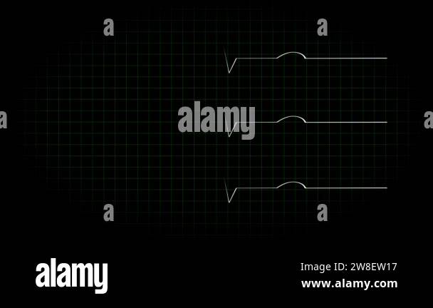 Electrocardiogram oscilloscope waveform animation motion graphics Stock ...