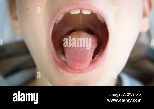 Wide Open Mouth Revealing Teeth Tongue Palate And Uvula