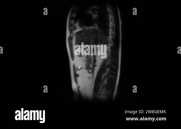 CT scan of the abdomen. Computed tomography of the gastrointestinal ...