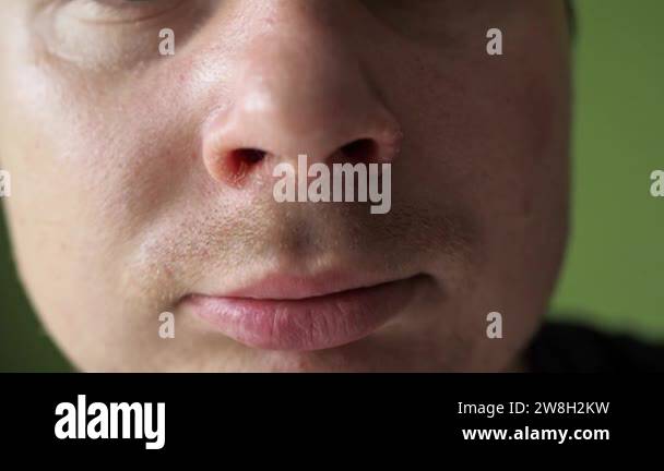 a sore nose after a runny nose close-up. cracked skin on the nose. sore ...