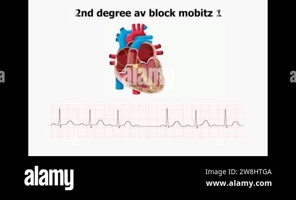 ecg shows 2d degree av block Mobitz 1 with heart animation Stock Video ...