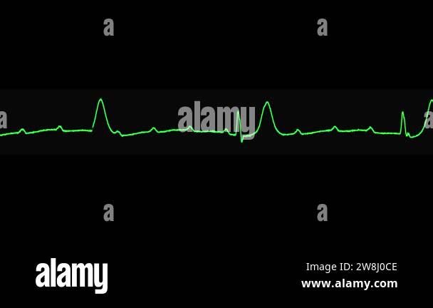 ecg shows complete av block (3rd degree av block) of the heart Stock ...