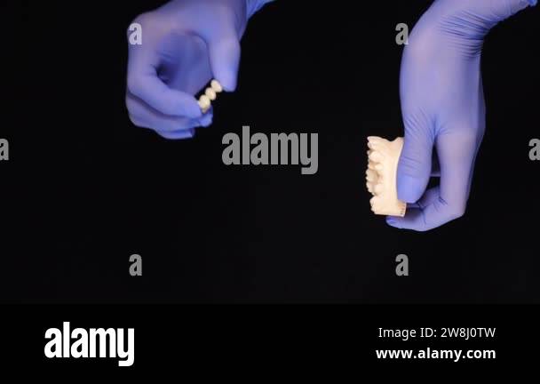 Dental concept on black background. Model of teeth and dental bridging ...