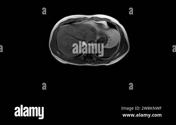 CT scan of the abdomen. Computed tomography of the gastrointestinal ...