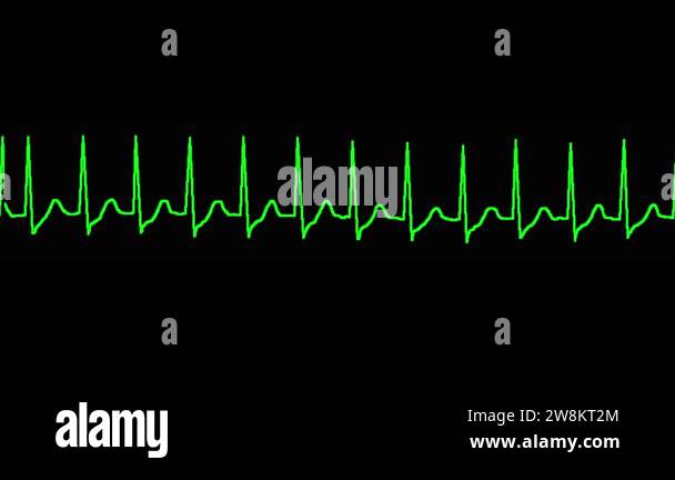 Paroxysmal Supraventricular Tachycardia (psvt)