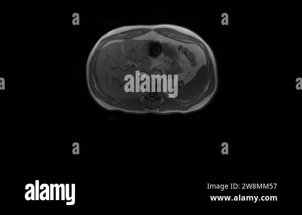 CT scan of the abdomen. Computed tomography of the gastrointestinal ...