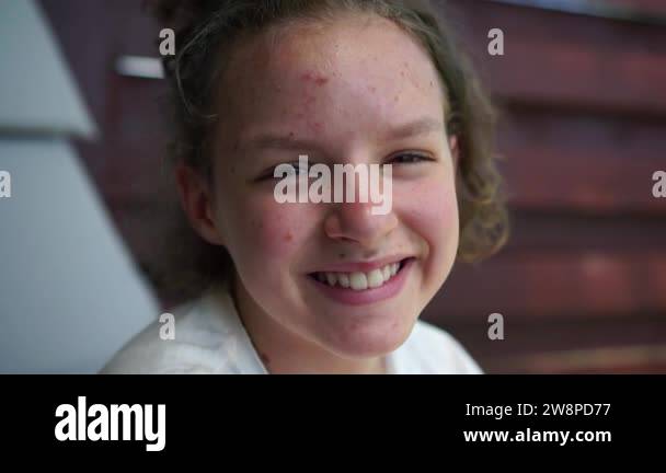 Close up portrait of a smiling bright teenage girl with teenage rashes ...