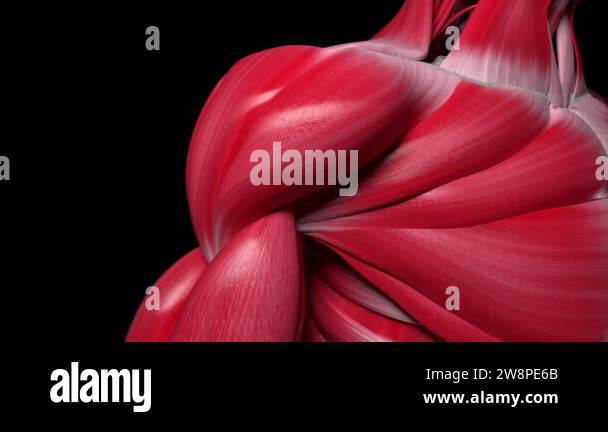 This 3d medical animation shows a shouder injury with large u tear of ...