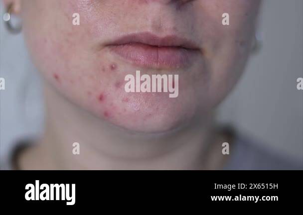 Close up of female face with red problematic acne skin, blurry ...