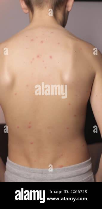 Allergy rash Stock Videos & Footage - HD and 4K Video Clips - Alamy